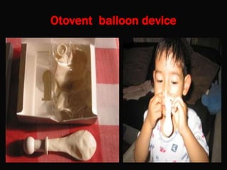 Otitis Media With Effusion | PPT