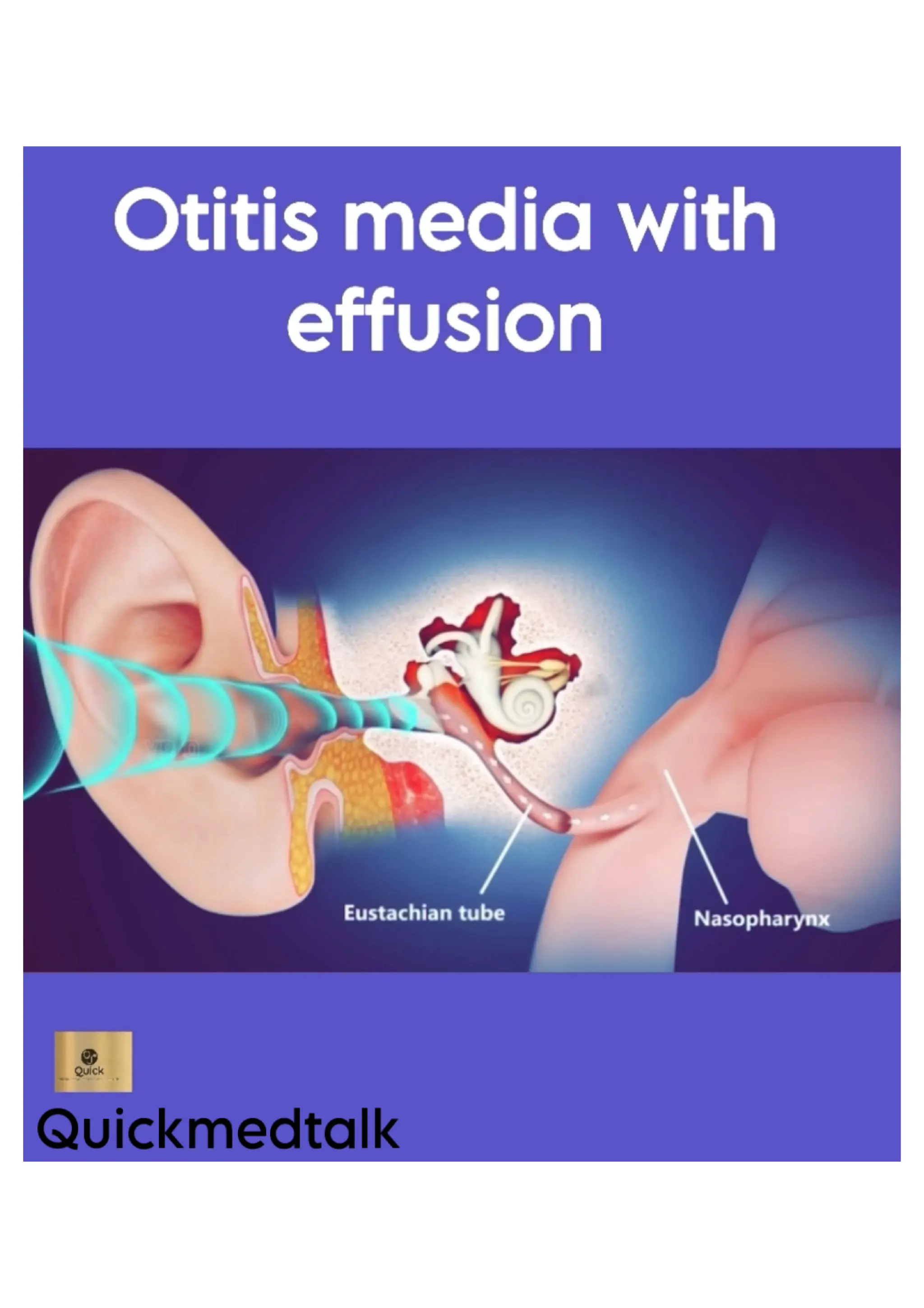 Otitis media with effusion .pdf ENT BY QUICKMEDTALK | PDF