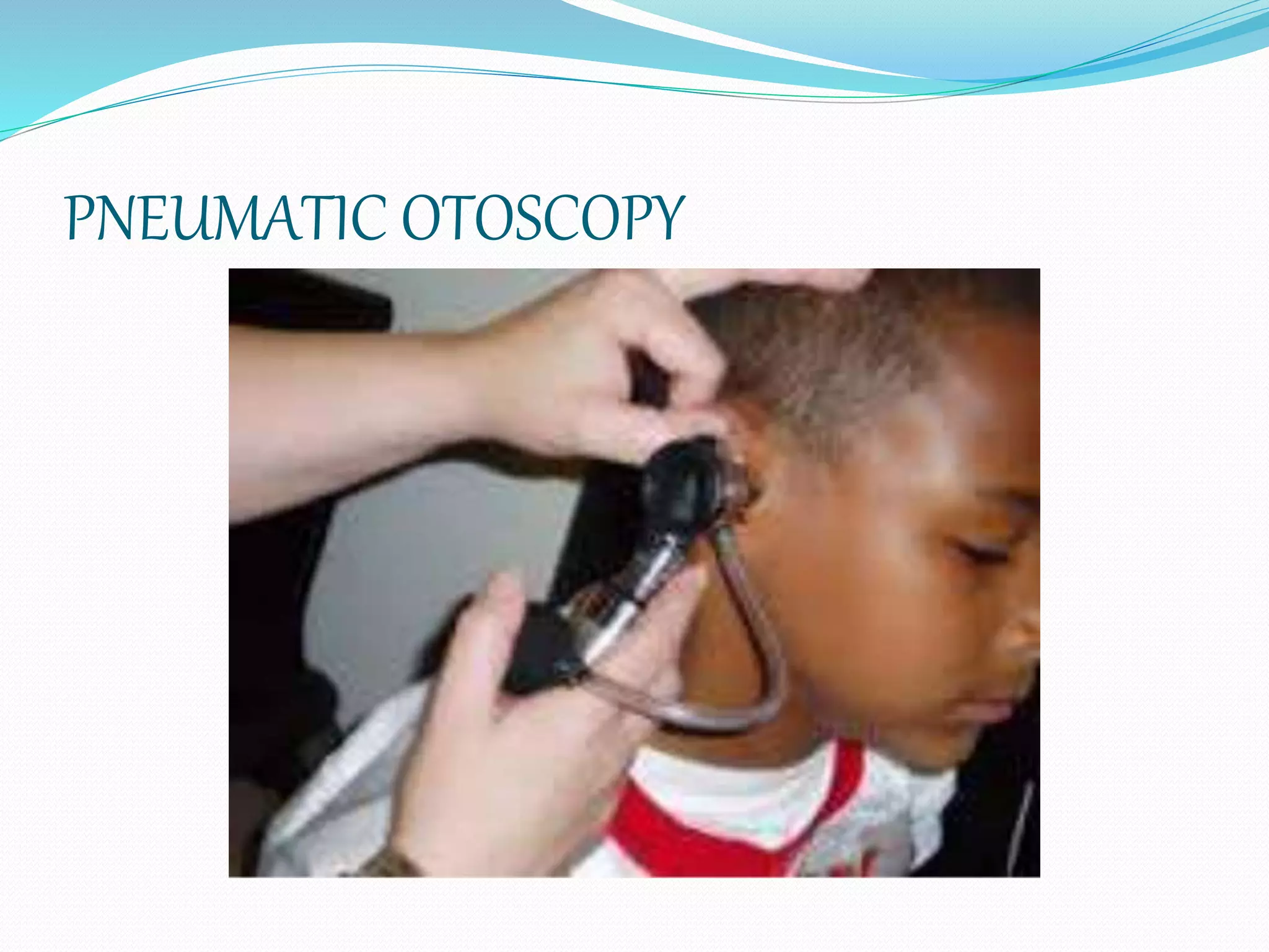 Otitis media with effusion | PPTX