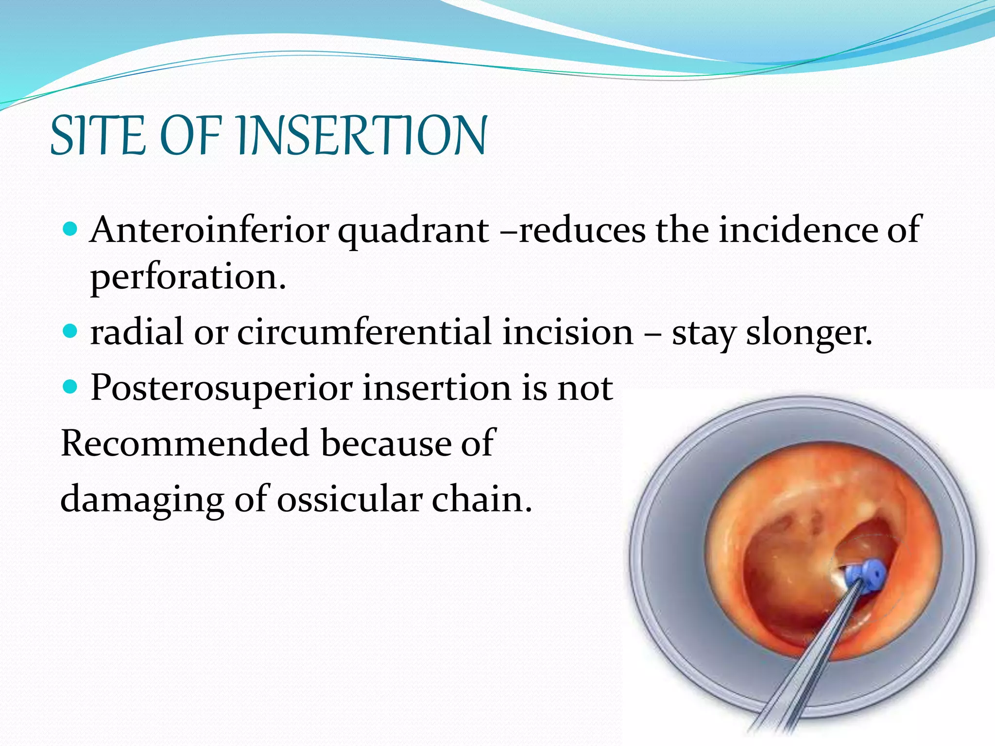 Otitis media with effusion | PPTX