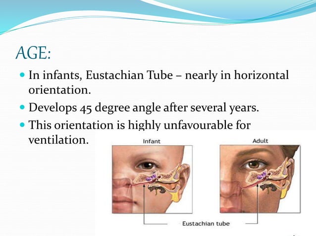 Otitis media with effusion | PPTX | Ear, Nose and Throat Conditions ...