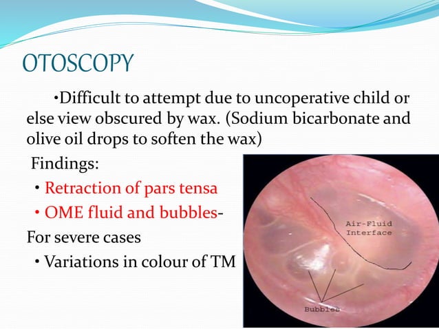 Otitis media with effusion | PPTX | Ear, Nose and Throat Conditions ...