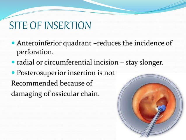 Otitis media with effusion | PPTX | Ear, Nose and Throat Conditions ...