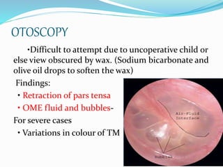 Otitis media with effusion | PPT