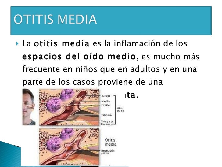 Otitis Media Y Otitis Externa: Síntomas, Causas Y Tratamiento – FRGIY