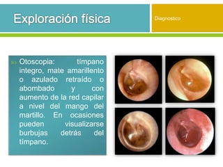 Otitis seromucosa | PPT