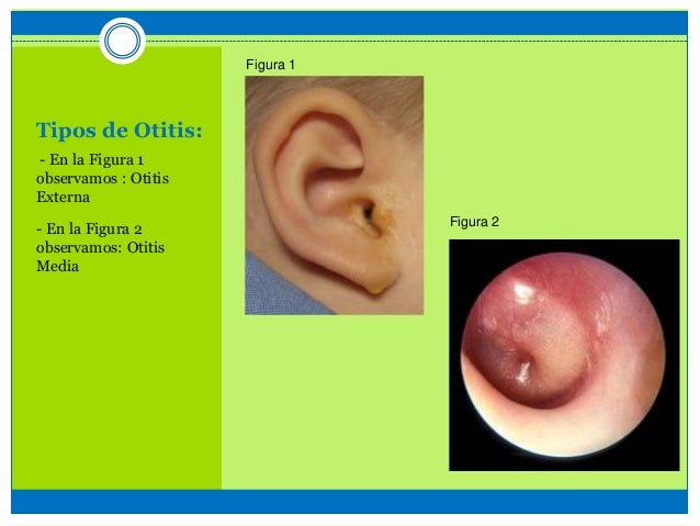 Tipos De Otitis Que Existen , Los 5 tipos de Sinusitis: causas ...