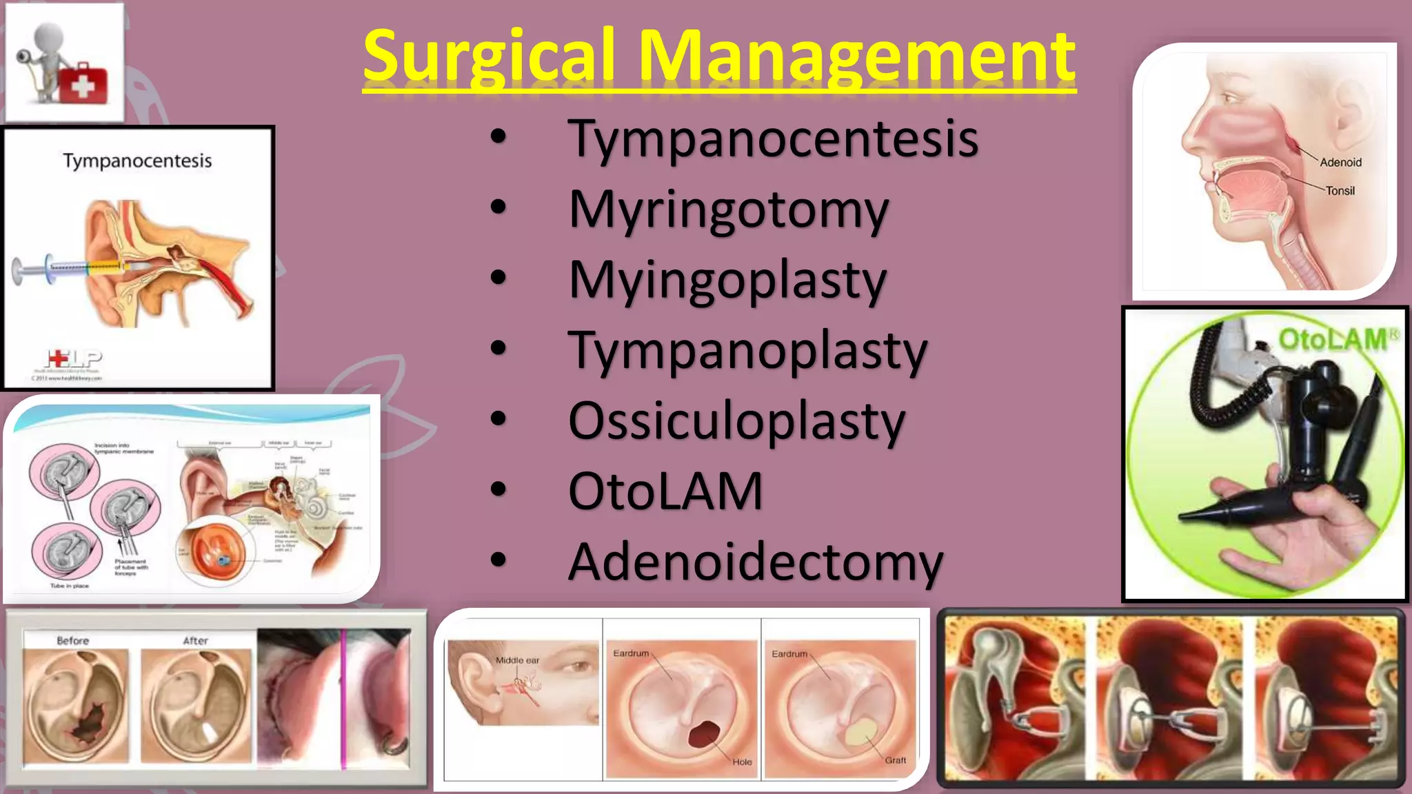 OTITIS MEDIA | PPTX