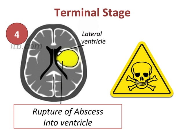 Otogenic brain abscess.pptx