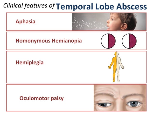 Otogenic brain abscess.pptx