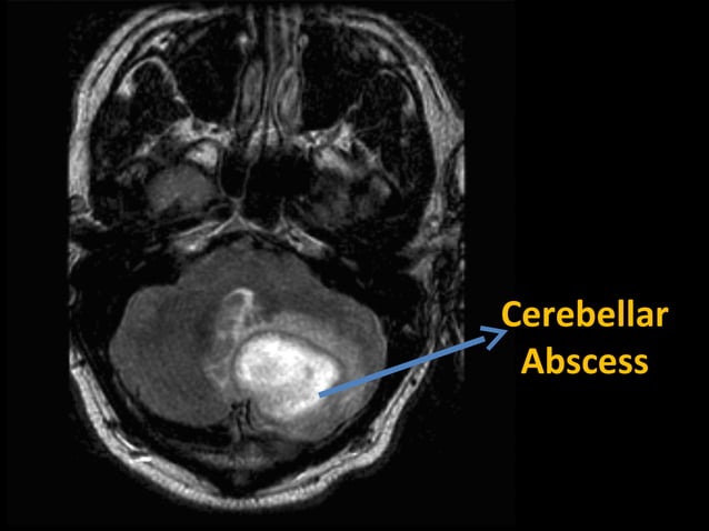 Otogenic brain abscess.pptx