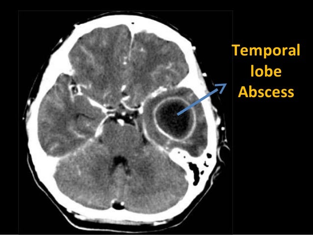 Otogenic brain abscess.pptx