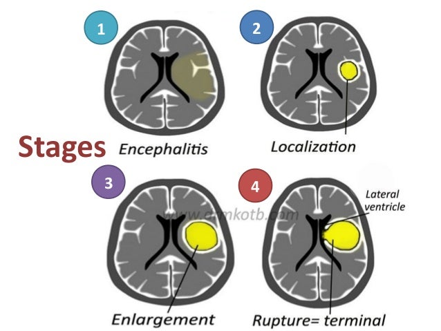 Otogenic brain abscess.pptx