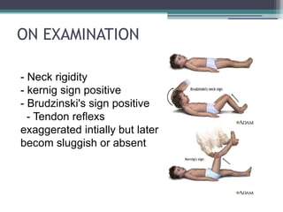 Otogenic Meningitis -Sanjay Ekka (110).ppt