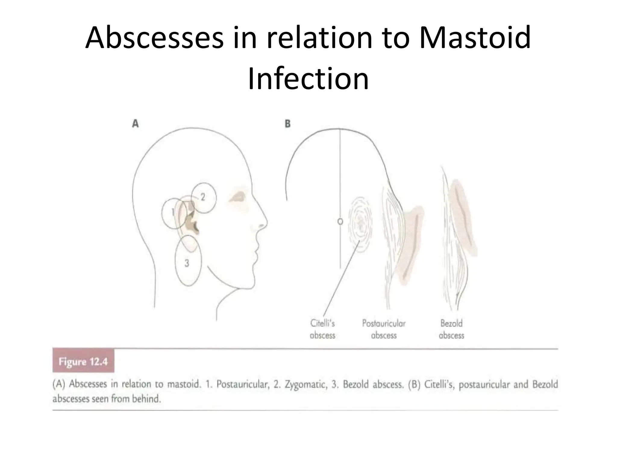 OTOLOGY POINTS & Post-auricular abscesses.pptx