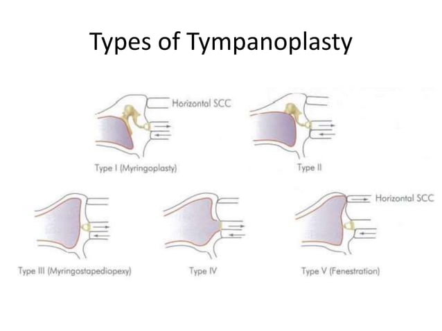 OTOLOGY POINTS & Post-auricular abscesses.pptx