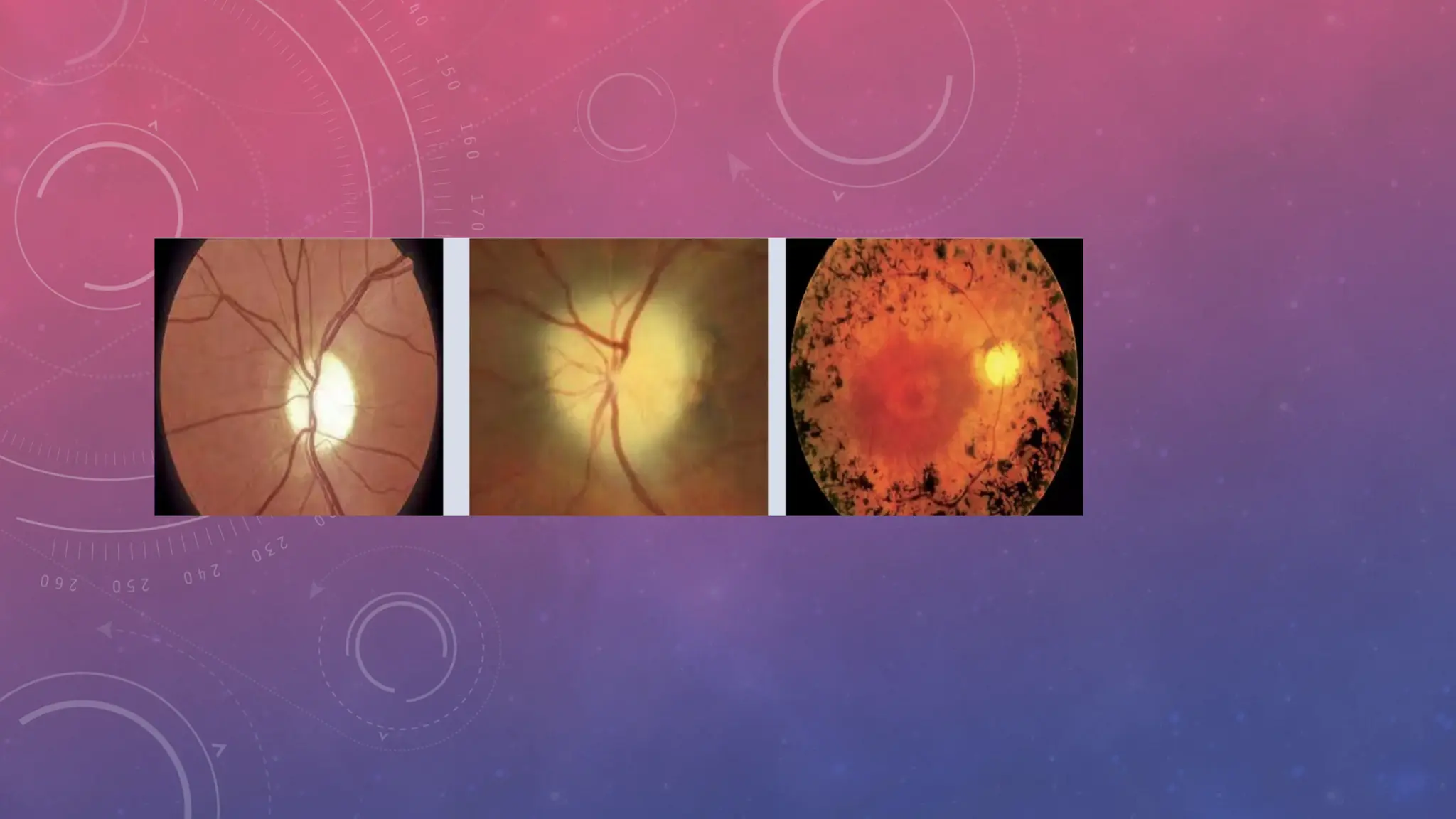 otomotiv edema papil dan teman tame.pptx