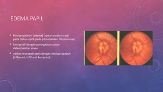 otomotiv edema papil dan teman tame.pptx