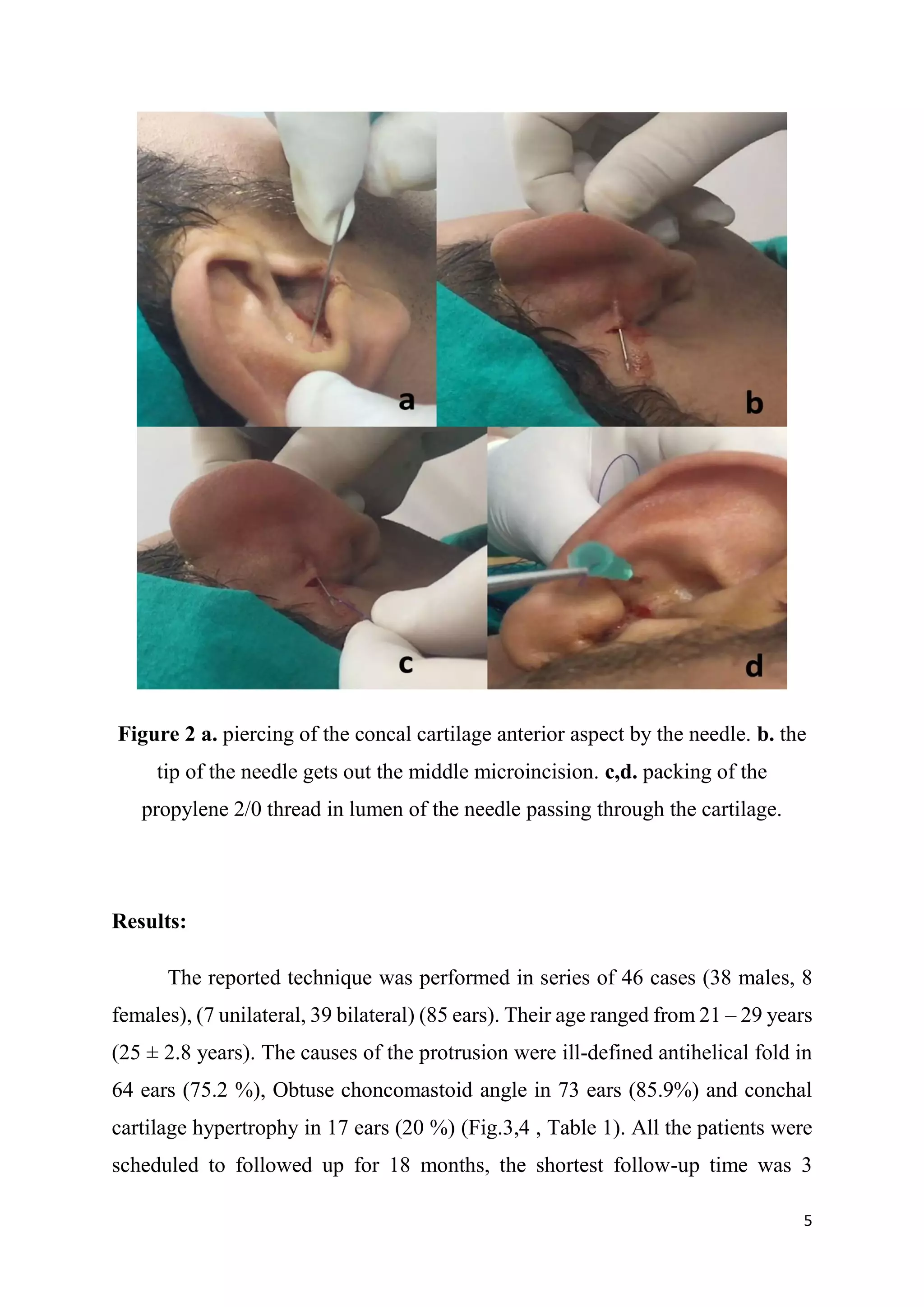 Otoplasty: New Modification of the Mustardé technique | PDF