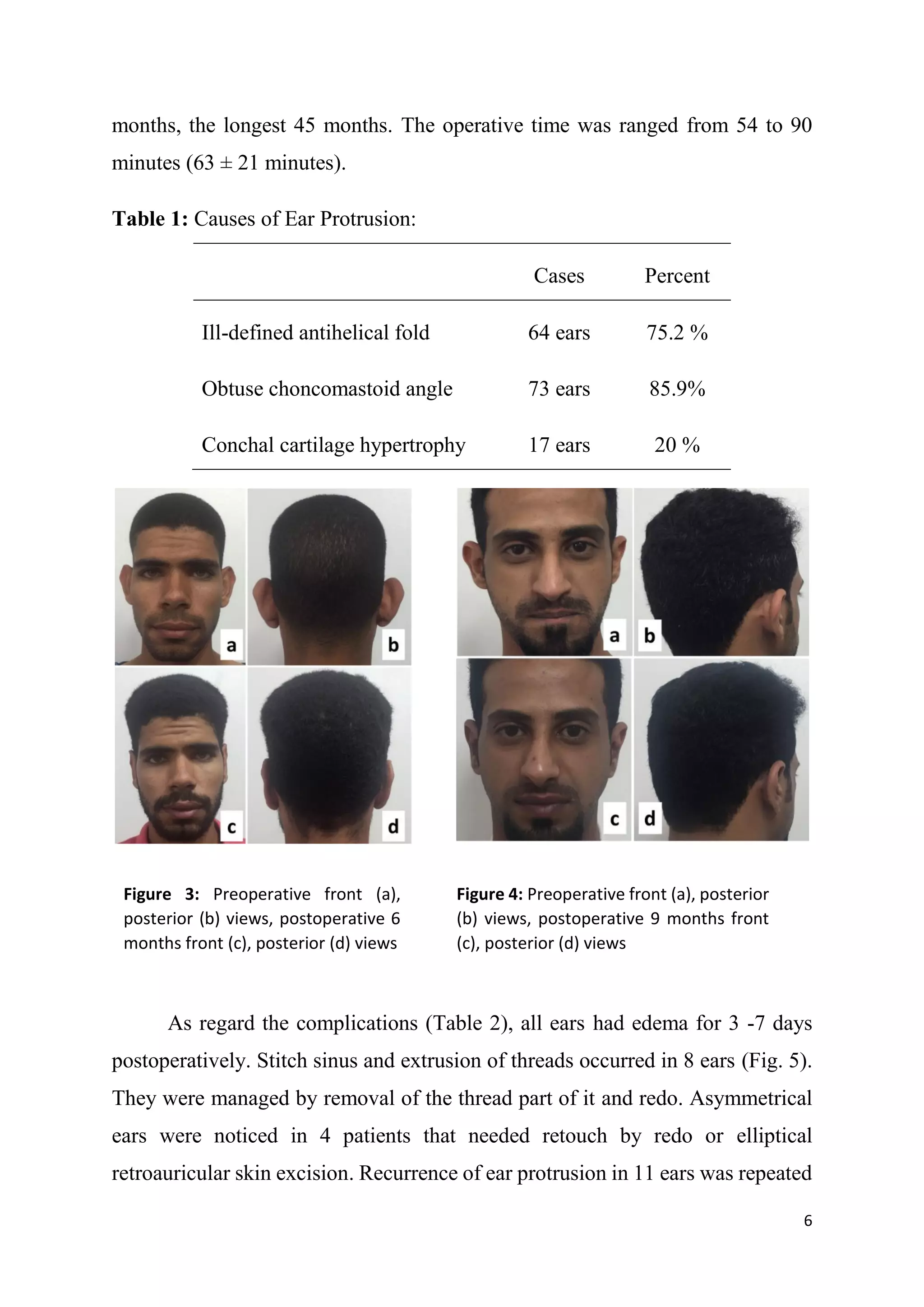 Otoplasty: New Modification of the Mustardé technique | PDF