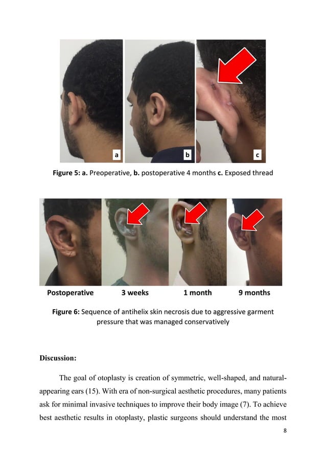 Otoplasty: New Modification of the Mustardé technique | PDF | Ear, Nose ...