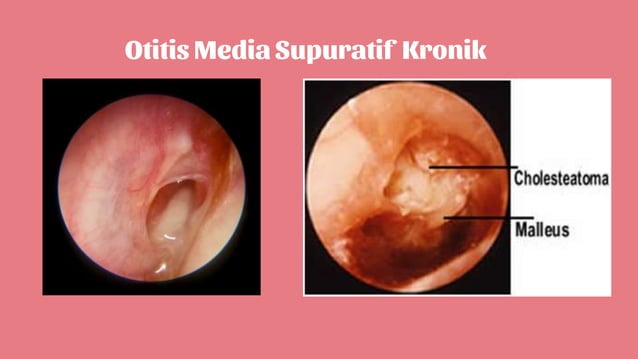 Otorea by Dheana Ismaniar | PPTX