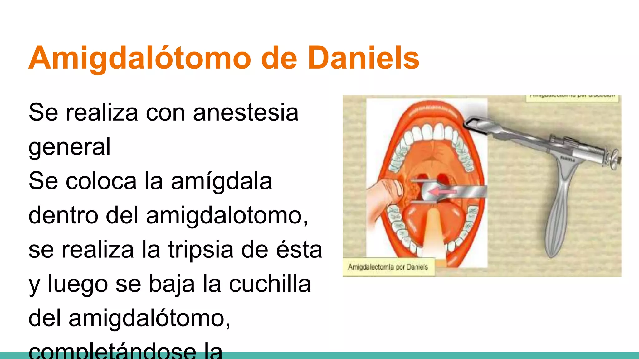 Amigdalectomia & Adenoidectomia | PPTX