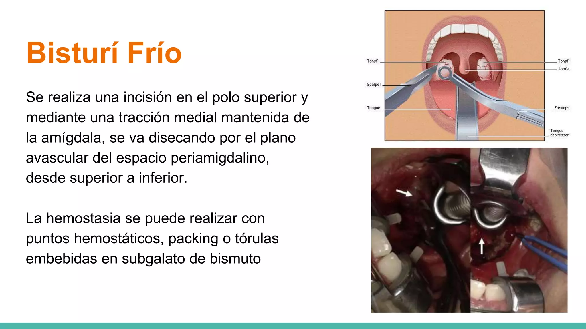 Amigdalectomia & Adenoidectomia | PPTX
