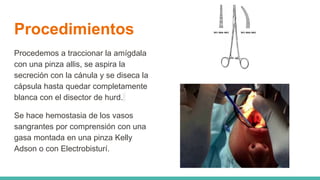 Amigdalectomia & Adenoidectomia | PPTX