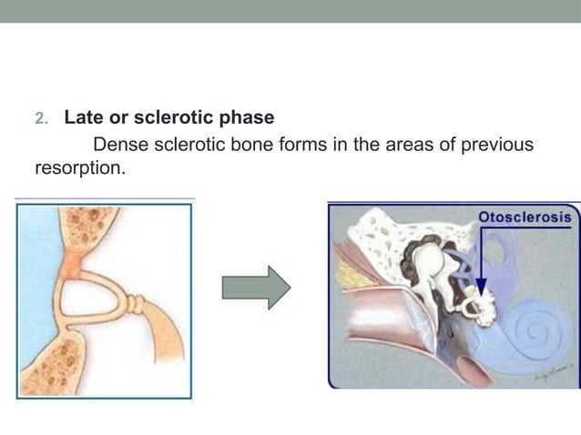 otosclerosis a middle ear pathology causing deafness | PPTX | Ear, Nose ...