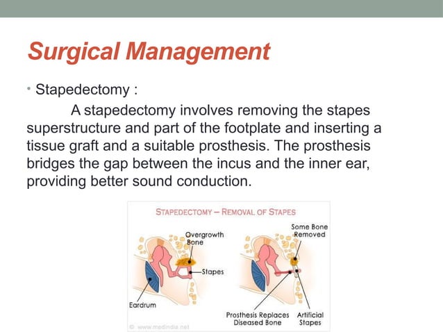 otosclerosis a middle ear pathology causing deafness | PPTX | Ear, Nose ...