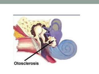 otosclerosis a middle ear pathology causing deafness | PPTX | Ear, Nose ...