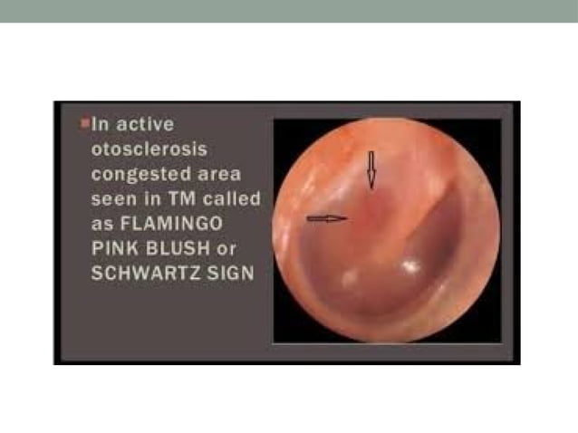 otosclerosis a middle ear pathology causing deafness | PPTX | Ear, Nose ...