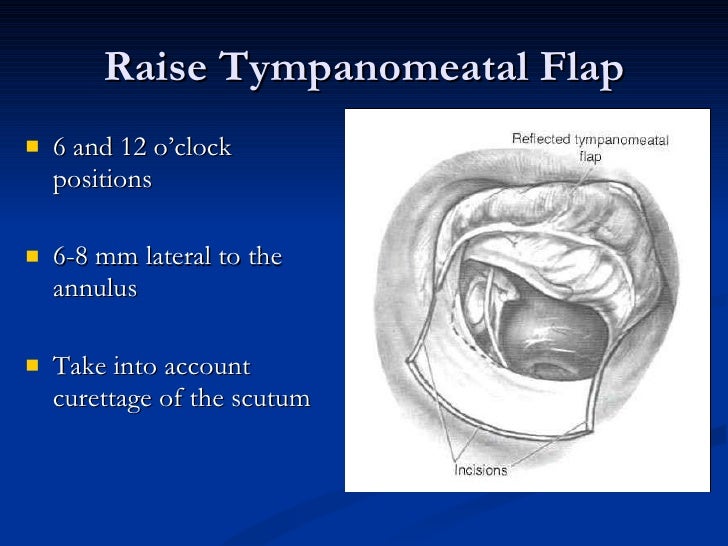 Otosclerosis
