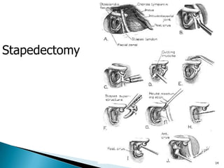 Otosclerosis | PPTX | Ear, Nose and Throat Conditions | Diseases and ...