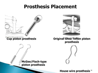Otosclerosis | PPTX | Ear, Nose and Throat Conditions | Diseases and ...