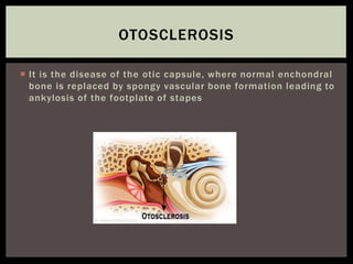 Otosclerosis | PPTX