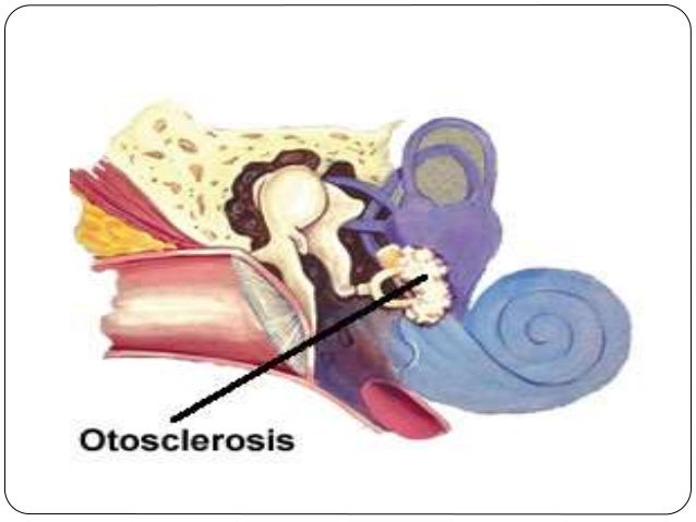 Otosclerosis