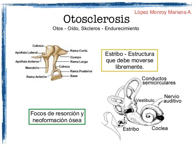 Otosclerosis