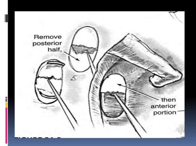 Otosclerosis | PPTX | Ear, Nose and Throat Conditions | Diseases and ...