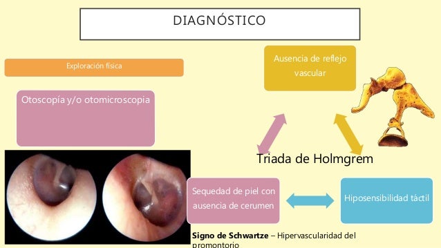Otosclerosis