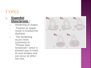 Otosclerosis | PPTX