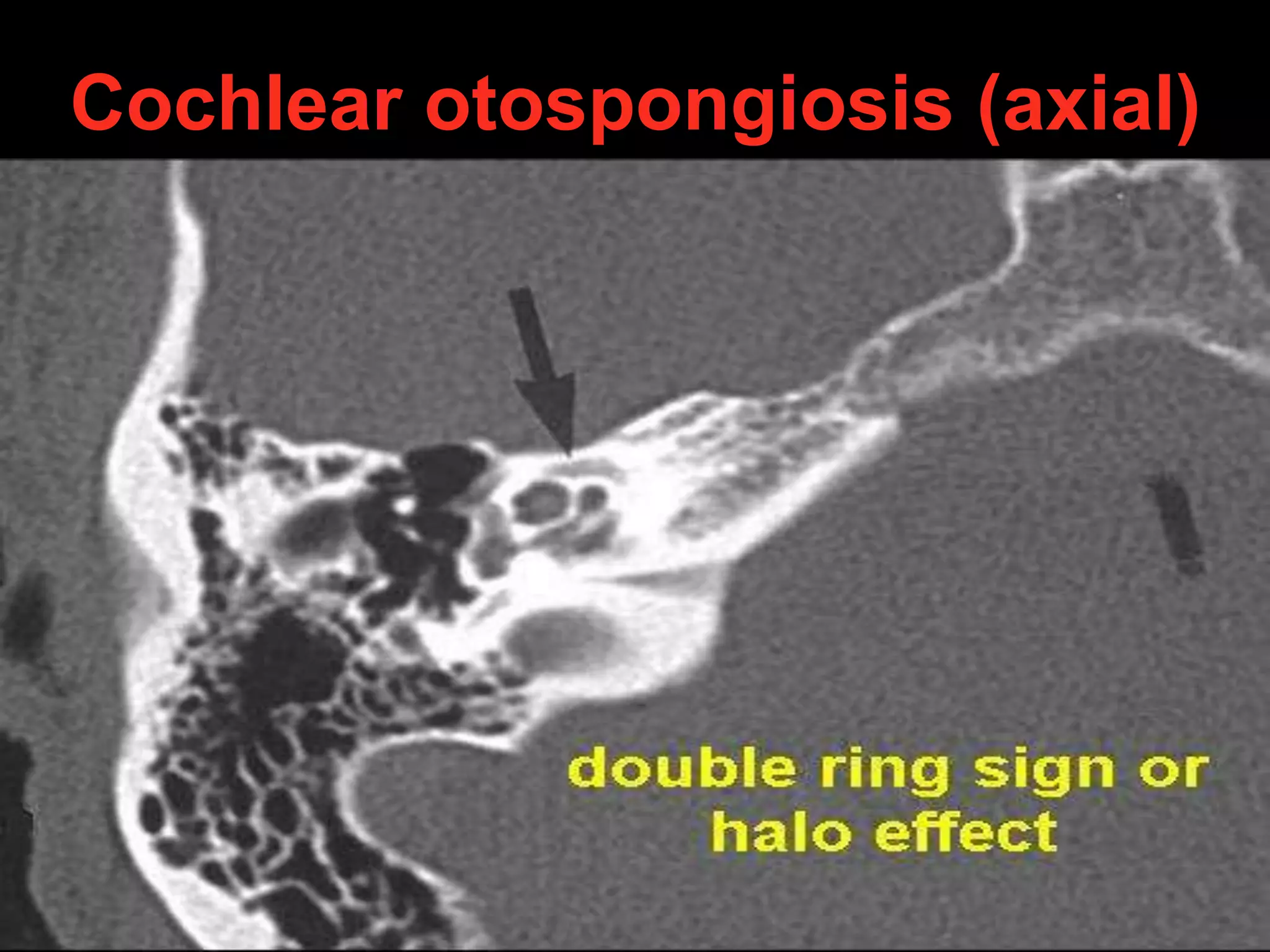 OTOSCLEROSIS | PPT