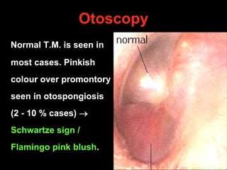 OTOSCLEROSIS | PPT