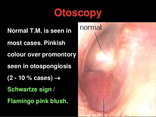 OTOSCLEROSIS