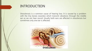 Otosclerosis | PPT