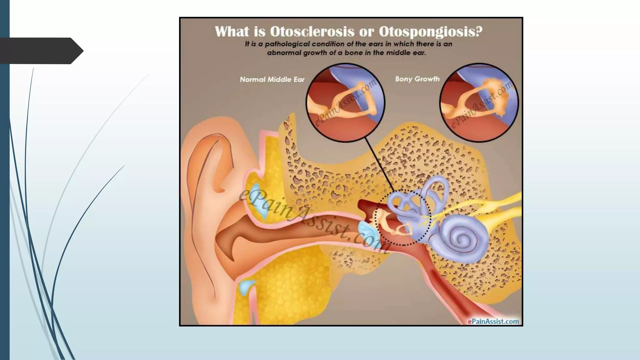 Otosclerosis | PPTX