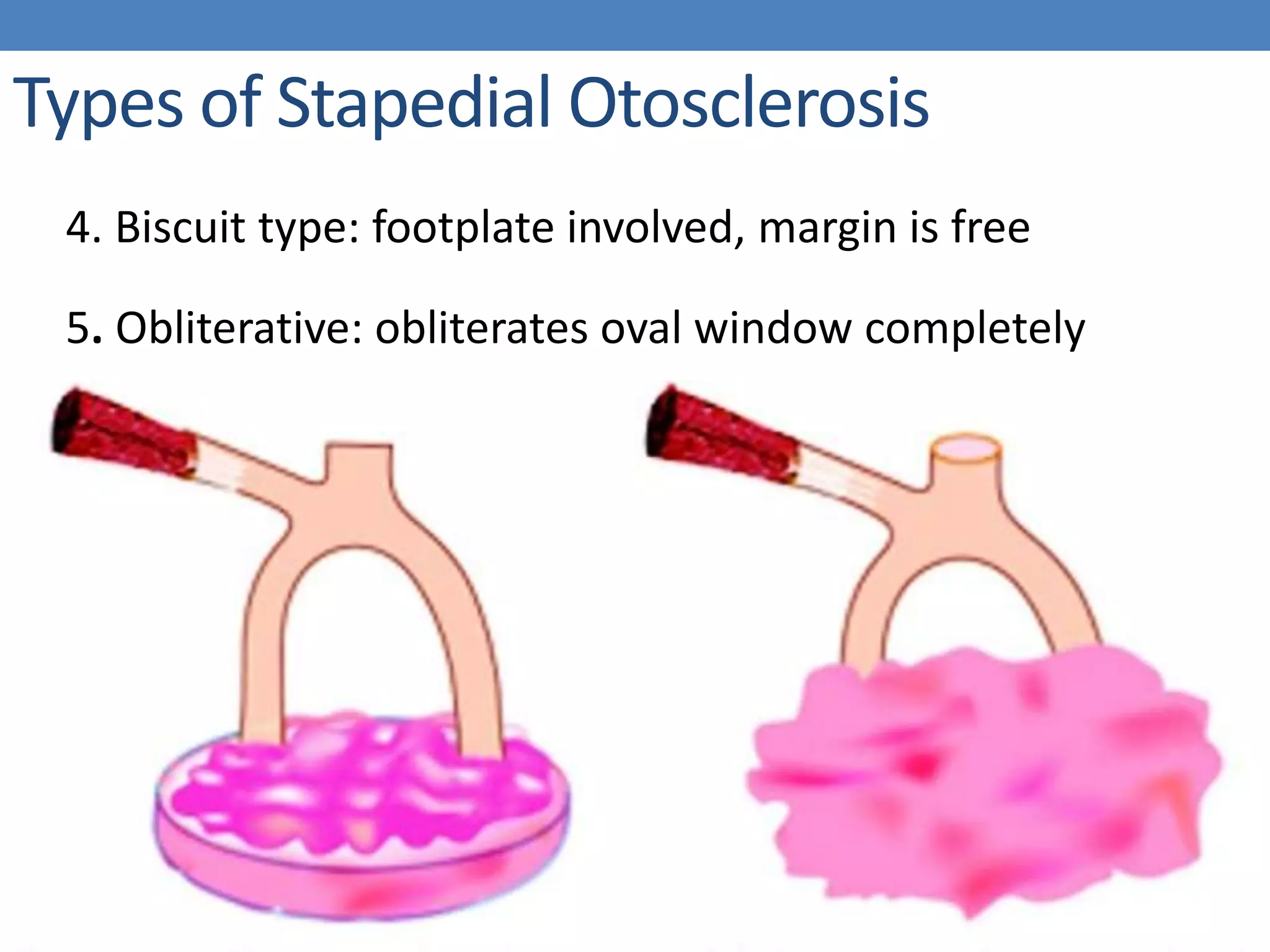 Otosclerosis | PPTX