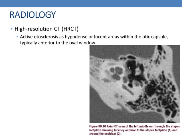 Otosclerosis | PPTX | Ear, Nose and Throat Conditions | Diseases and ...