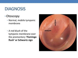 Otosclerosis Otoscopy
